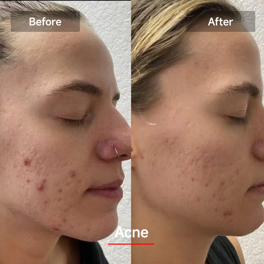 Megelin LED Red Light Therapy Face Mask: Enhance Skin Health at Home