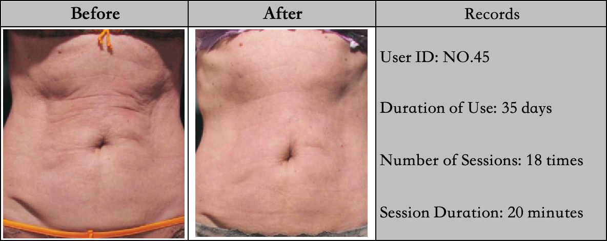 Red Light Therapy For Cellulite: 50 Users Results Before and After ...