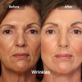 Megelin LASER&LED Light Therapy Mask