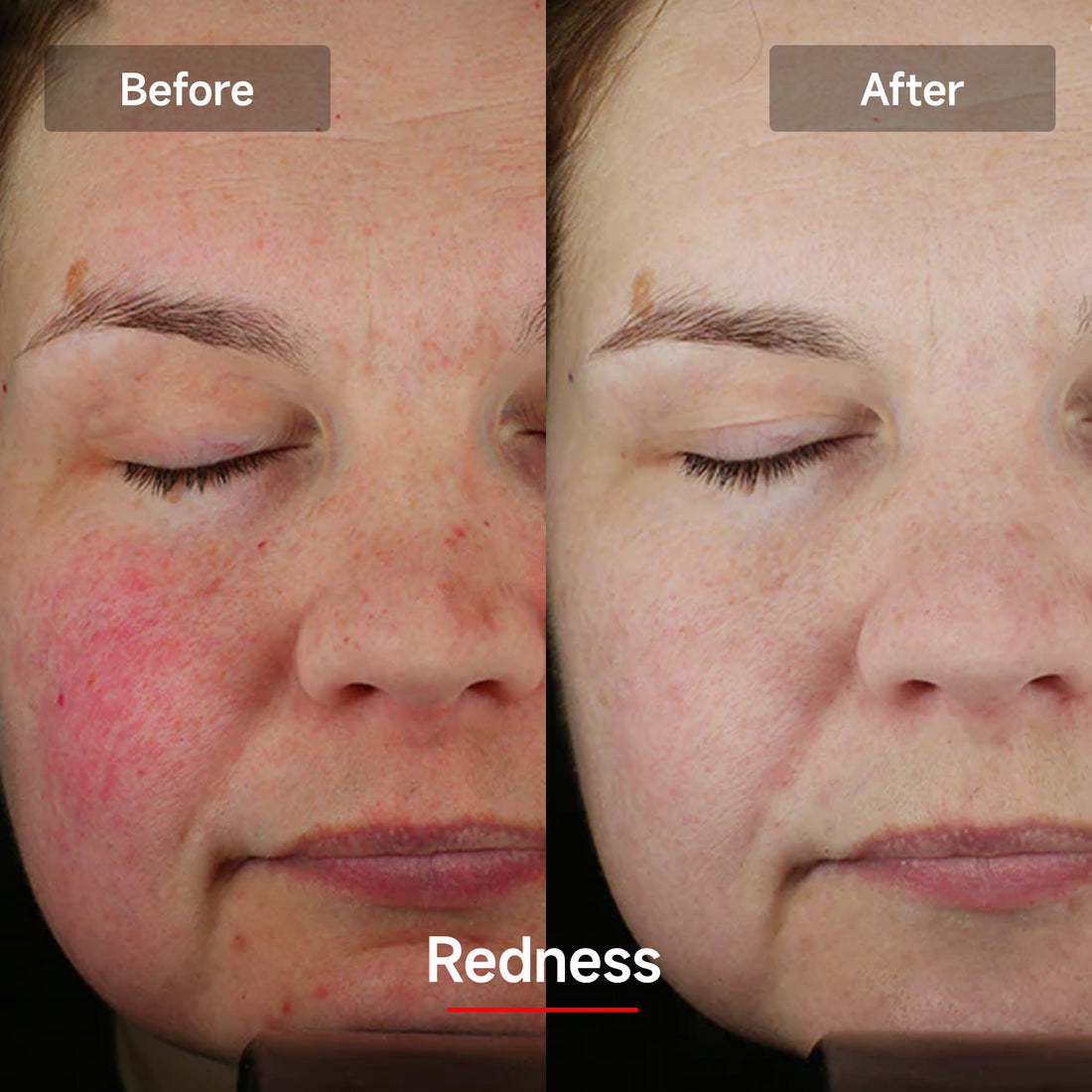 Megelin LASER&LED Light Therapy Mask