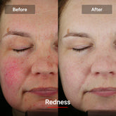 Megelin LASER&LED Light Therapy Mask