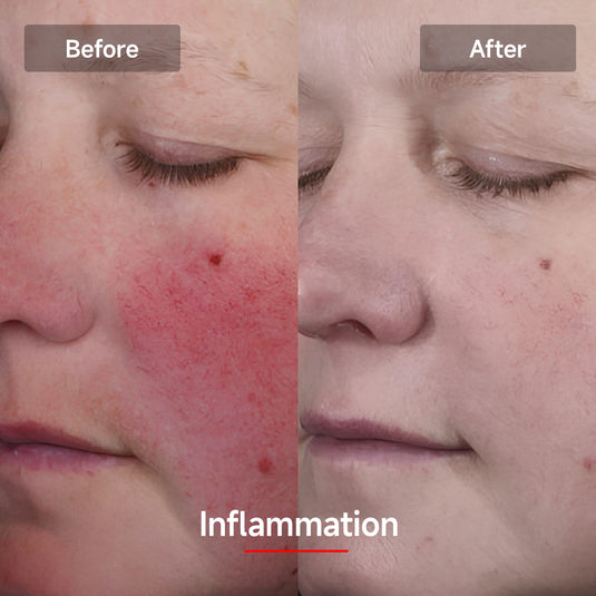 Megelin LASER&LED Light Therapy Mask